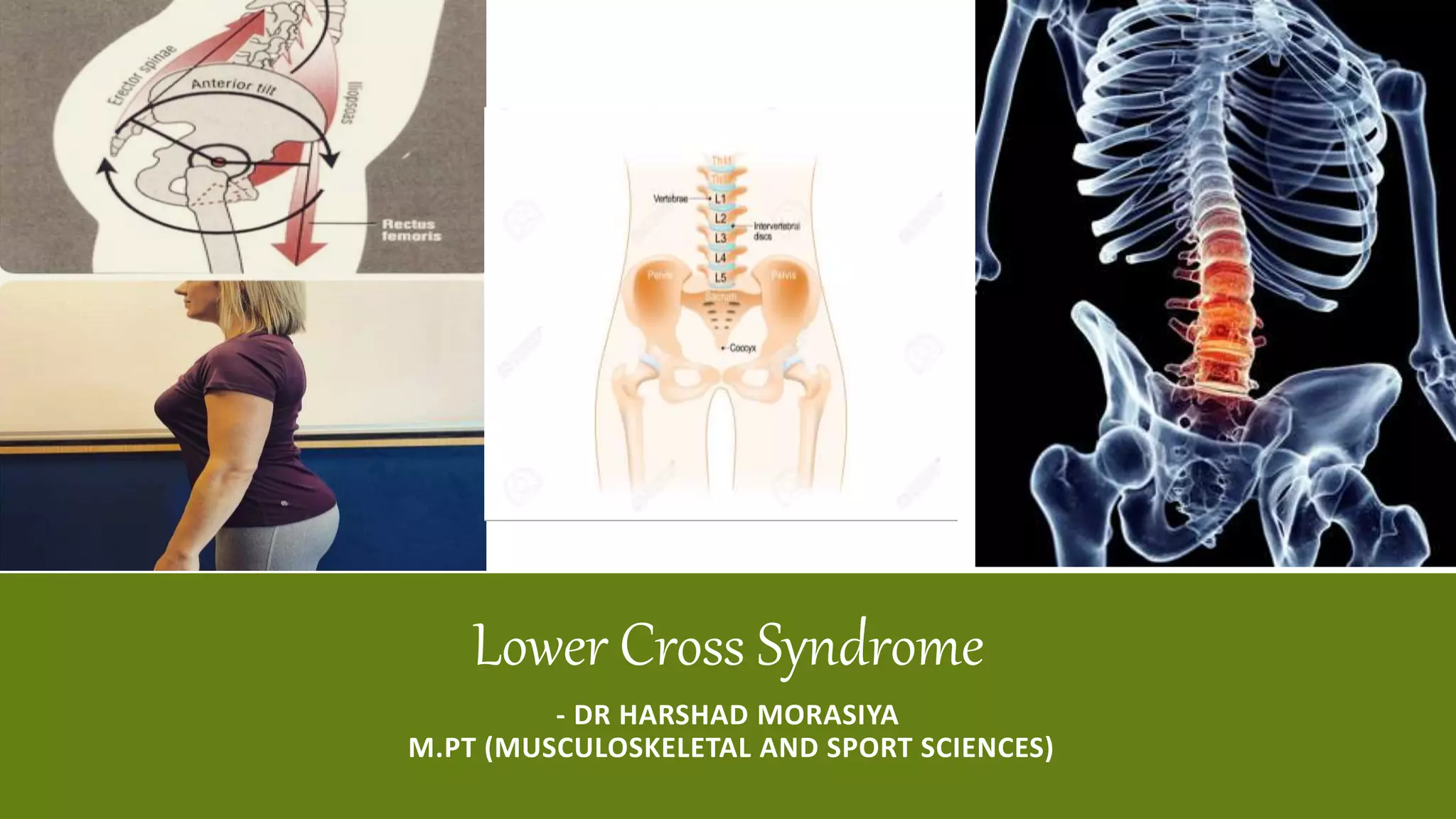 Lower cross syndrome | PPTX