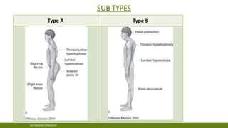 Lower cross syndrome | PPTX
