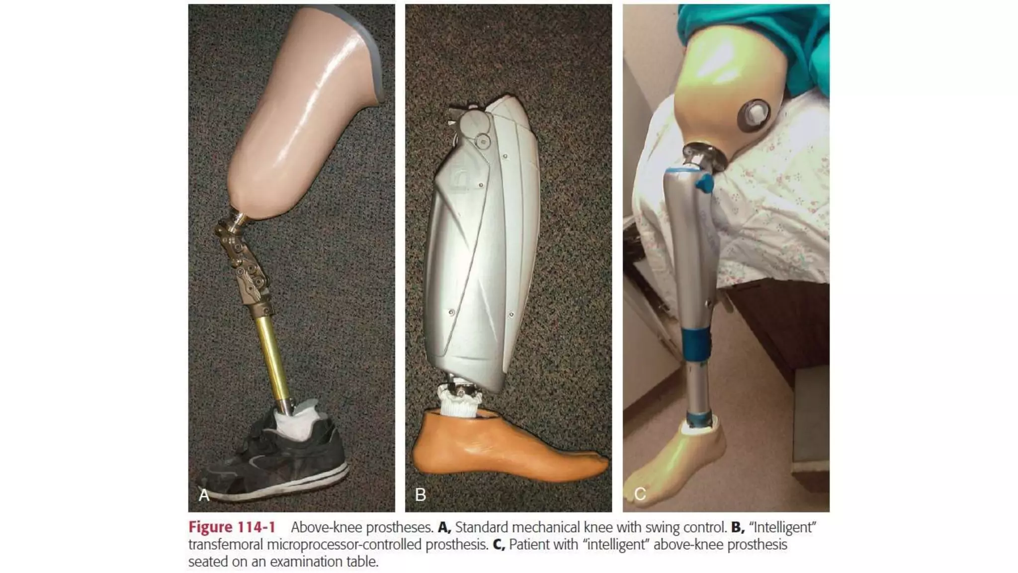 Lower extremity amputation | PPT