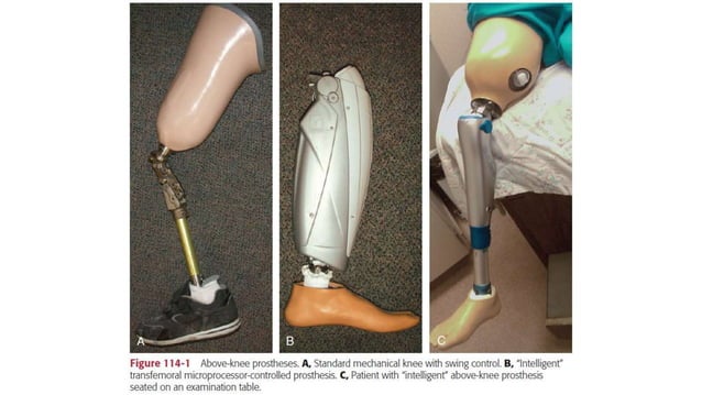 Lower extremity amputation | PPT | Physical Therapy | Wellness