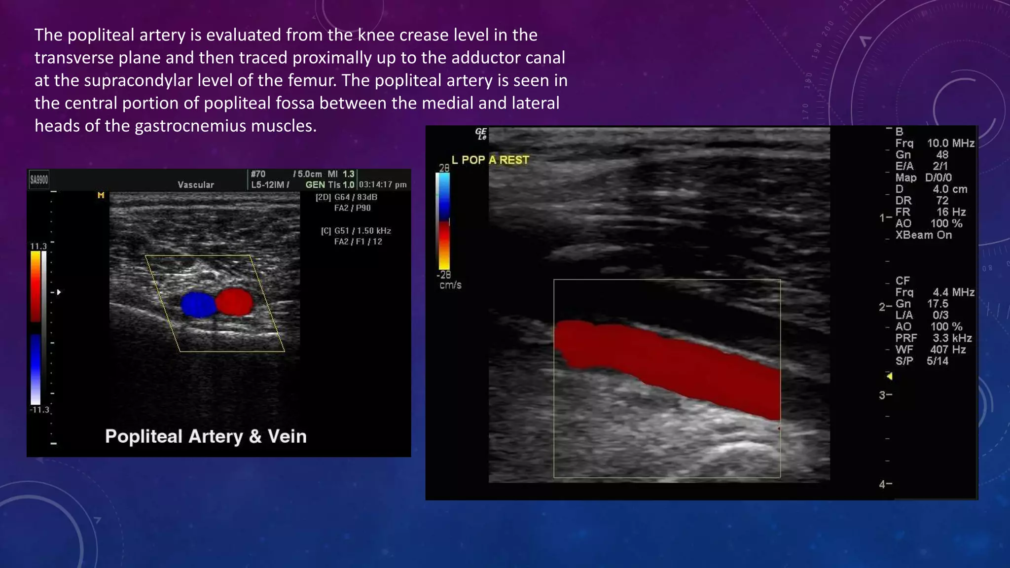 lower extremity doppler ultrasound.pptx