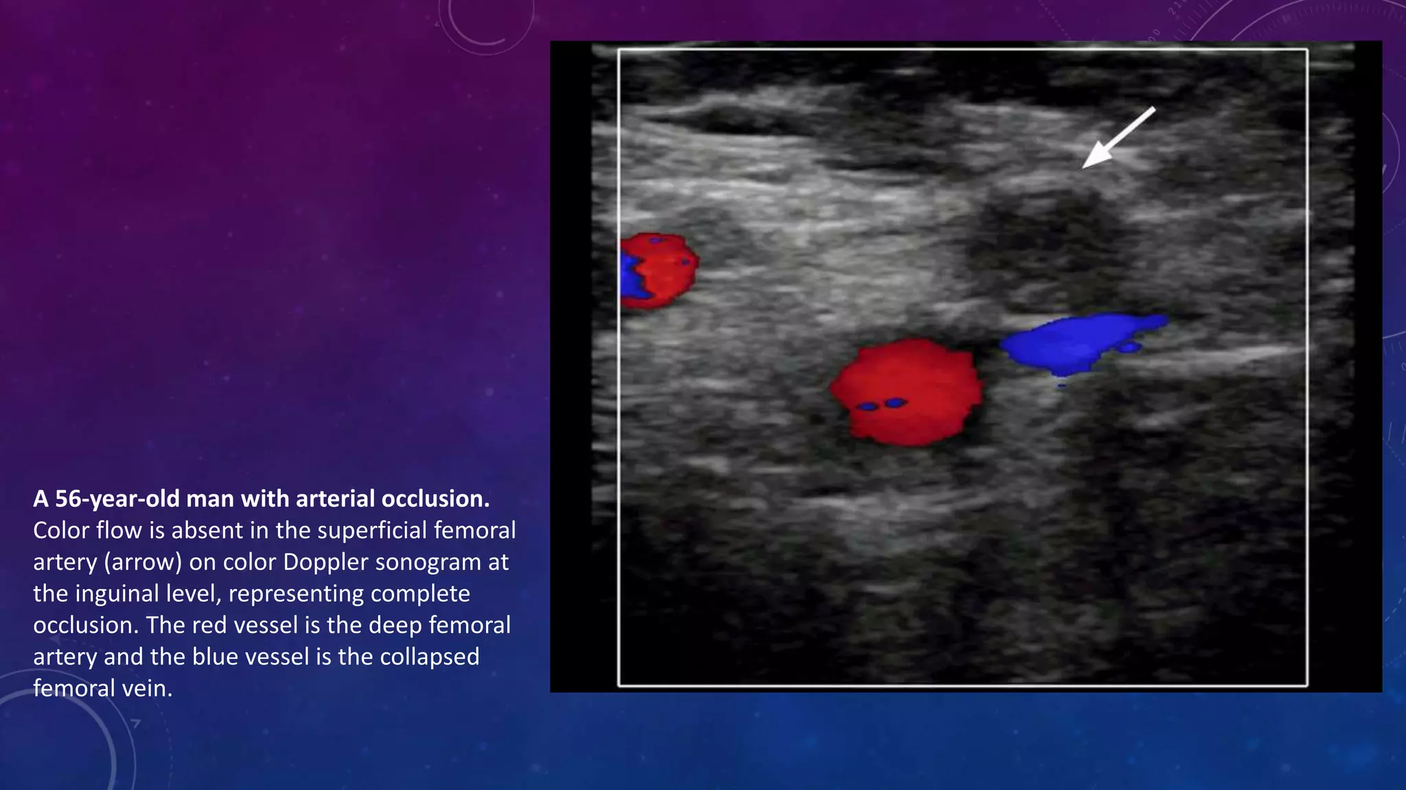 lower extremity doppler ultrasound.pptx