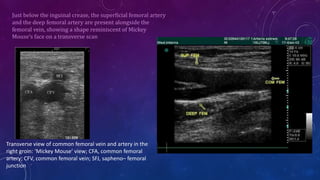 lower extremity doppler ultrasound.pptx