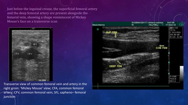 lower extremity doppler ultrasound.pptx | Death, Injury, or Military ...