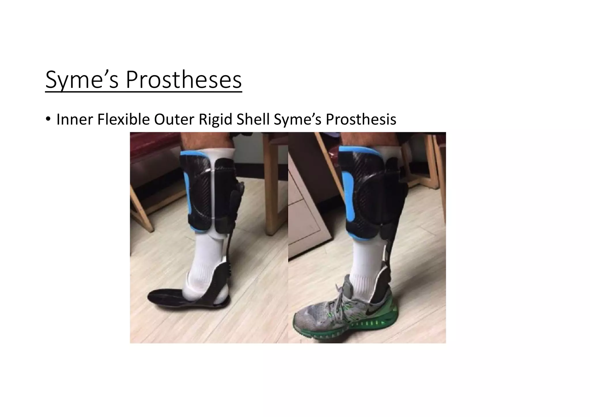 Lower extremity prostheses | PDF
