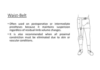 Lower extremity prostheses | PDF