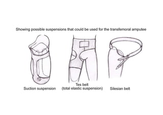 Silesian Bandage
