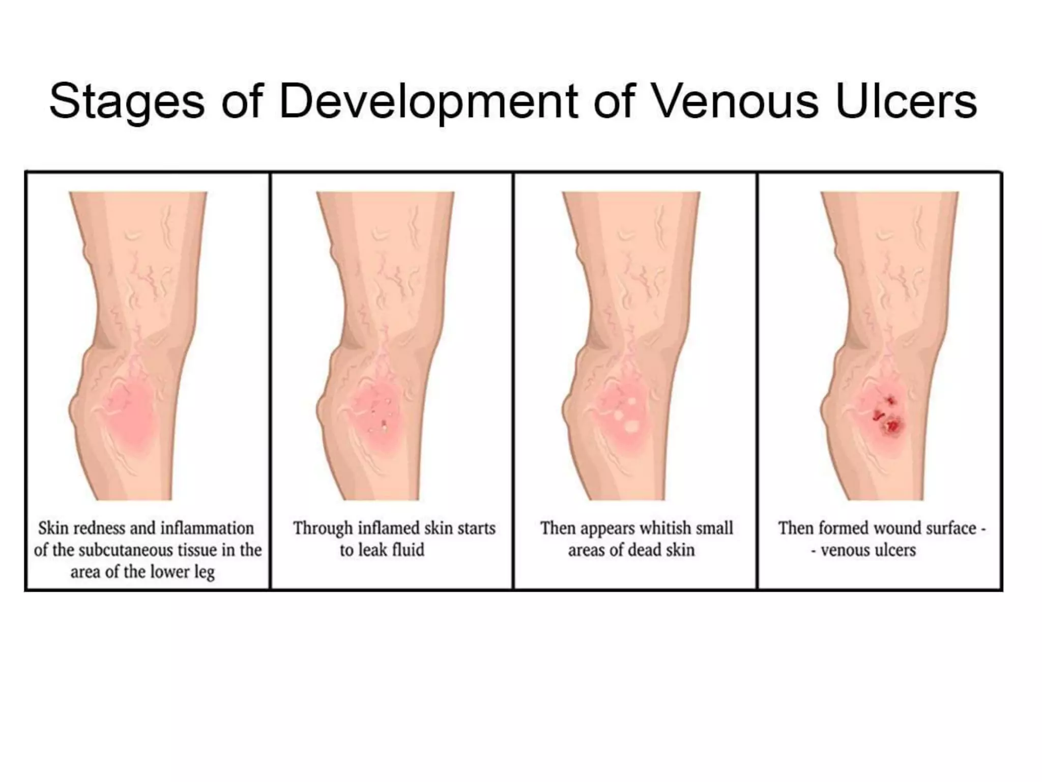 Lower Extremity Ulcers Final Pptpptx