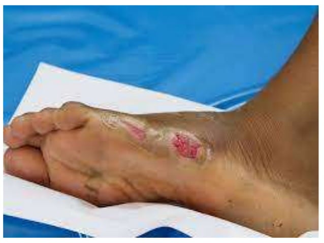 LOWER EXTREMITY ULCERS-FINAL PPT..pptx | Foot Health | Diseases and ...