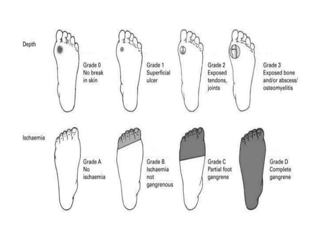 LOWER EXTREMITY ULCERS-FINAL PPT..pptx | Foot Health | Diseases and ...