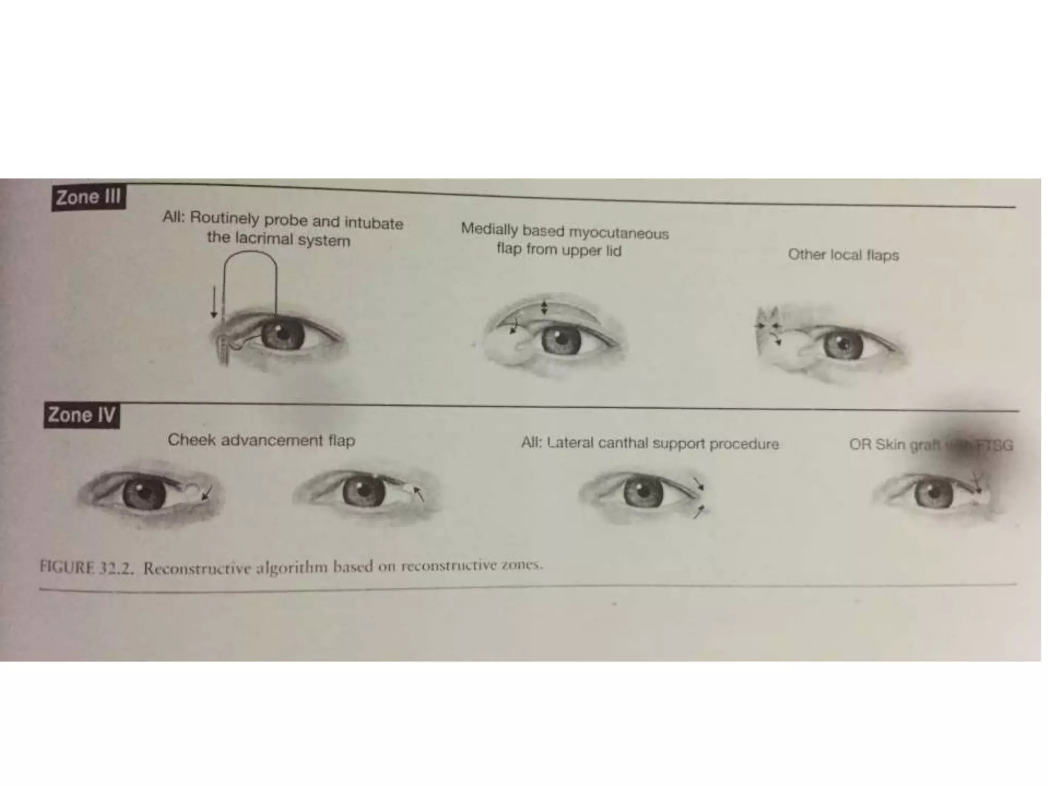 Lower eyelid reconstruction | PPTX