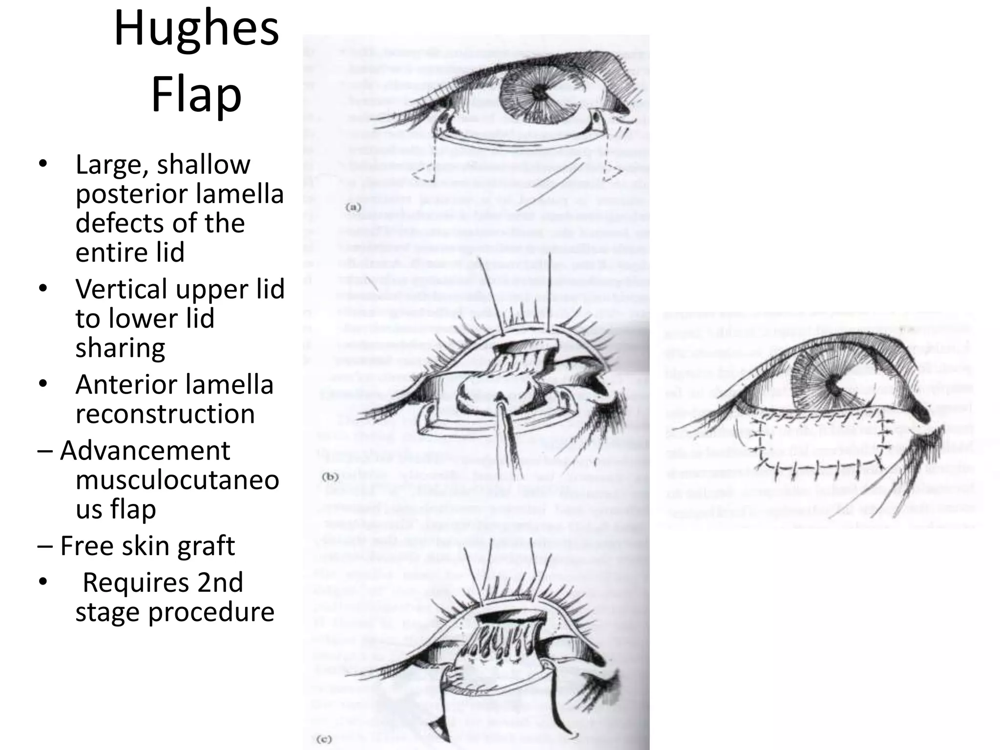 Lower eyelid reconstruction | PPTX