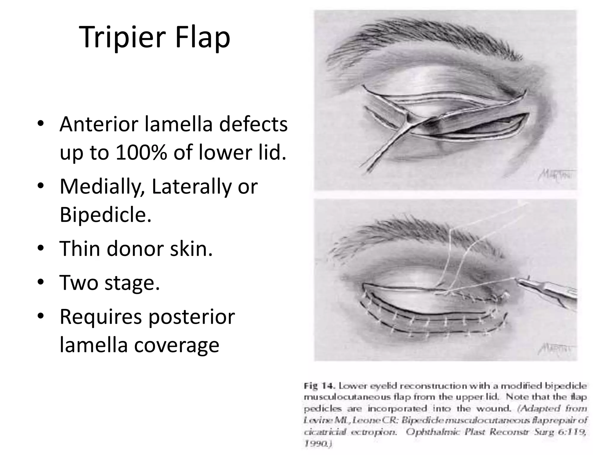 Lower eyelid reconstruction | PPTX