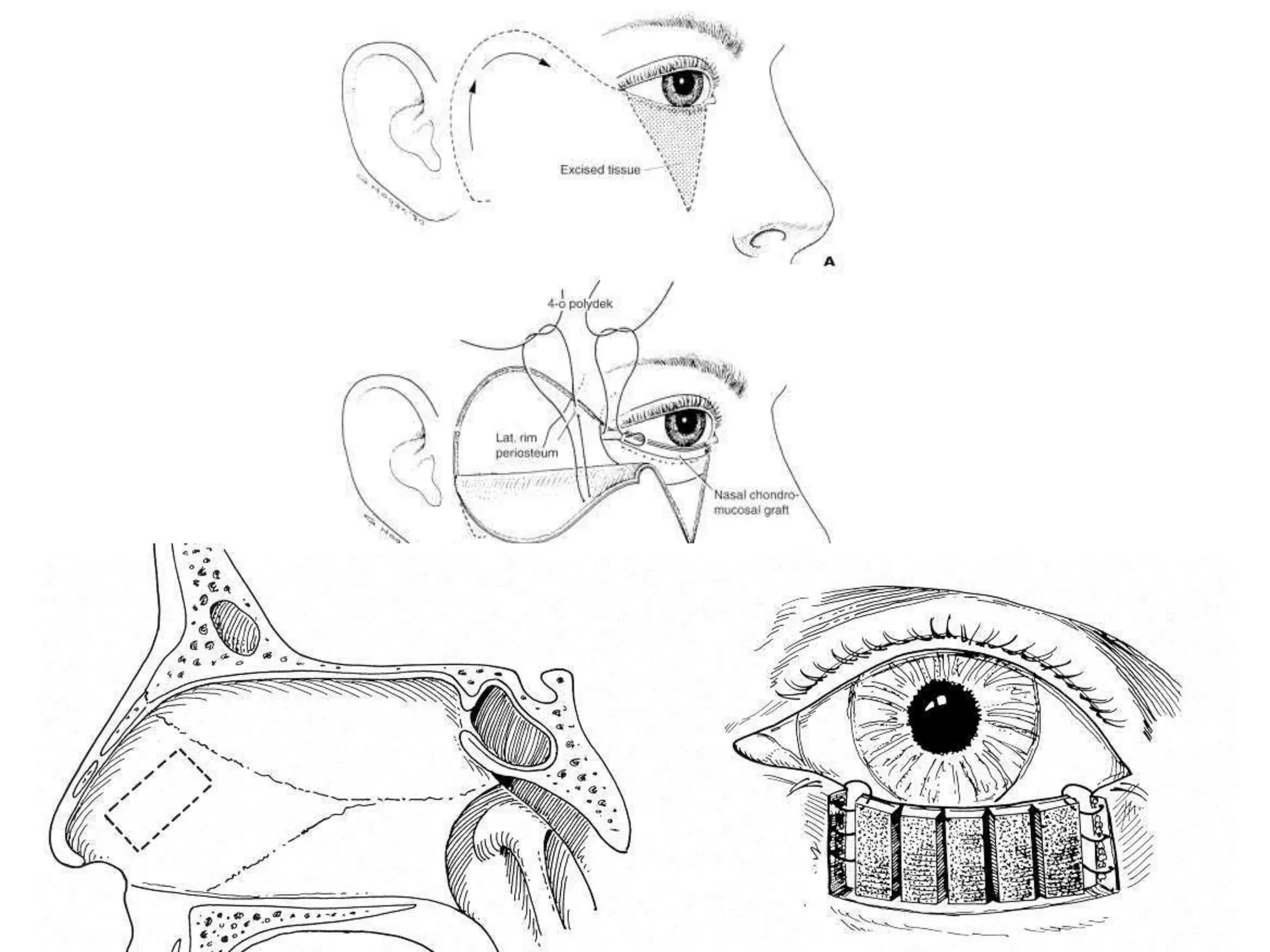Lower eyelid reconstruction | PPTX