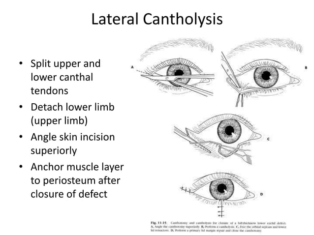 Lower eyelid reconstruction | PPTX