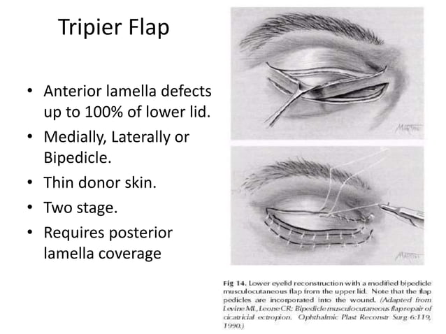 Lower eyelid reconstruction | PPTX