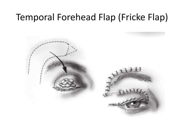 Lower eyelid reconstruction | PPTX