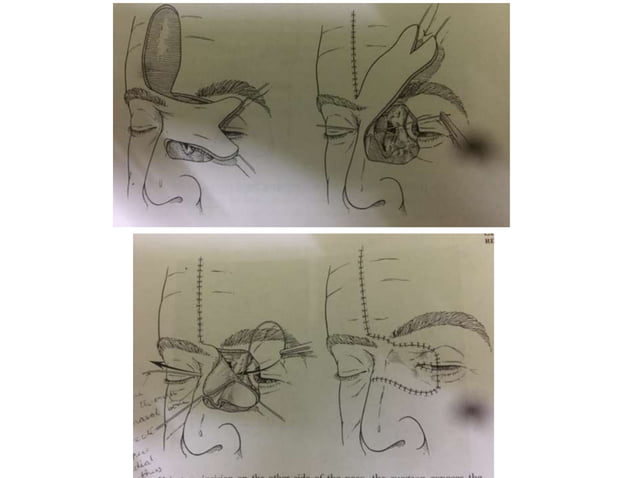 Lower eyelid reconstruction | PPTX