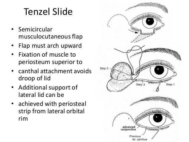 Lower eyelid reconstruction