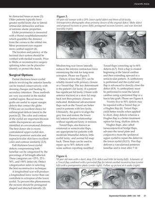 Eyelid Reconstruction from Cancer | PDF