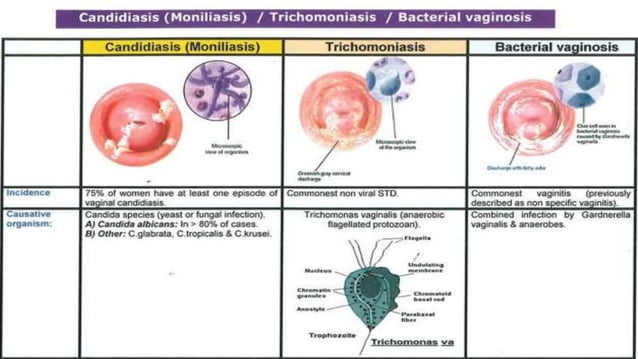 Lower Genital Tract Infection Tutorial Pptx