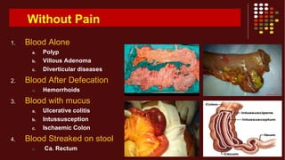 Lower GI Bleed (Lower Gastro intestinal Bleed) | PDF