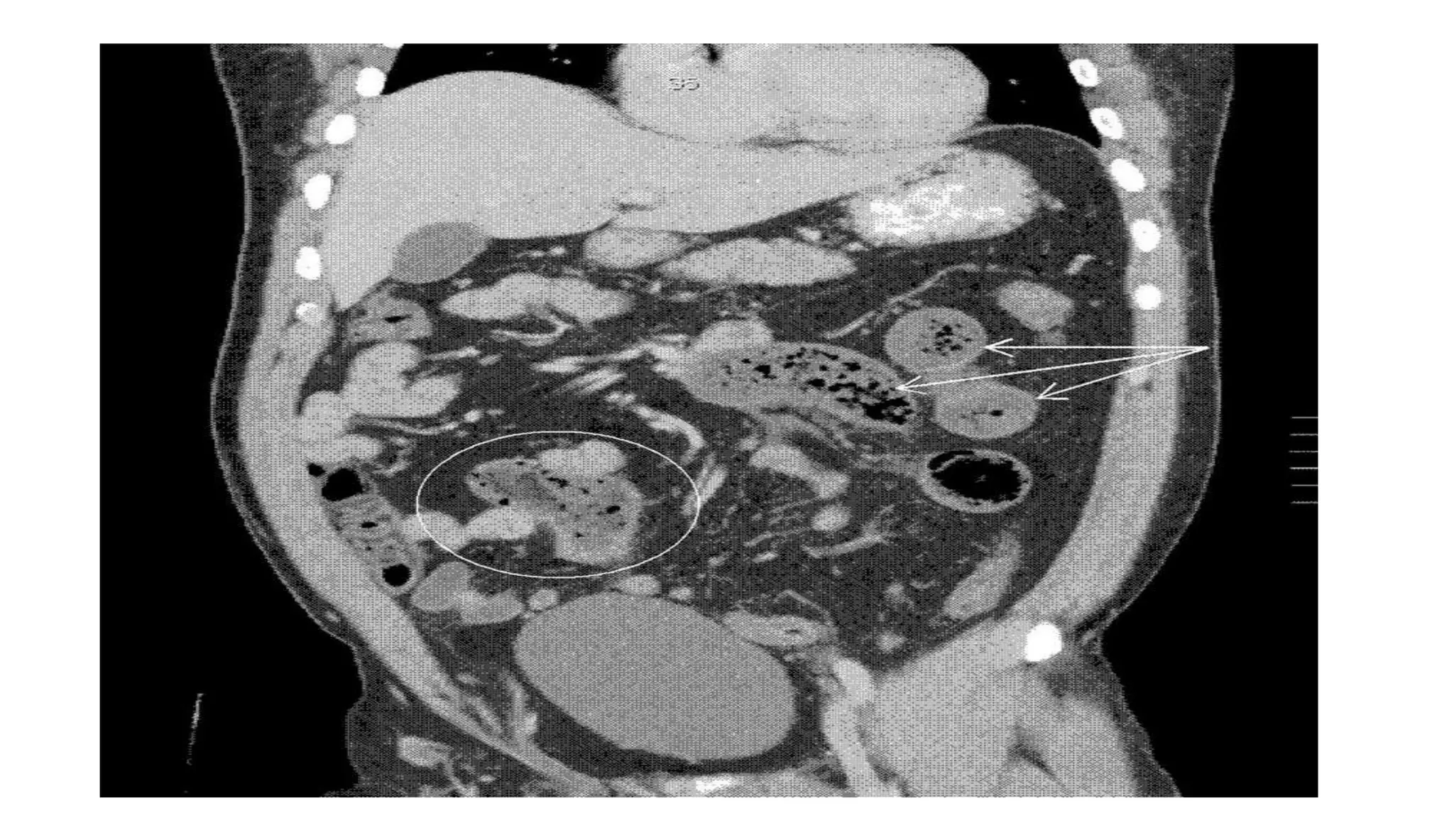 lower gastro-intestinal ANOMALIES. power point | PPTX