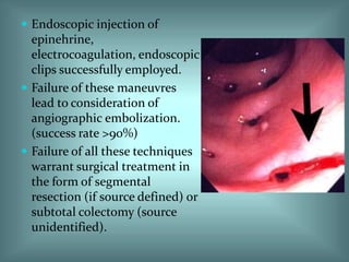 Lower Gastro-Intestinal Bleed | PPTX