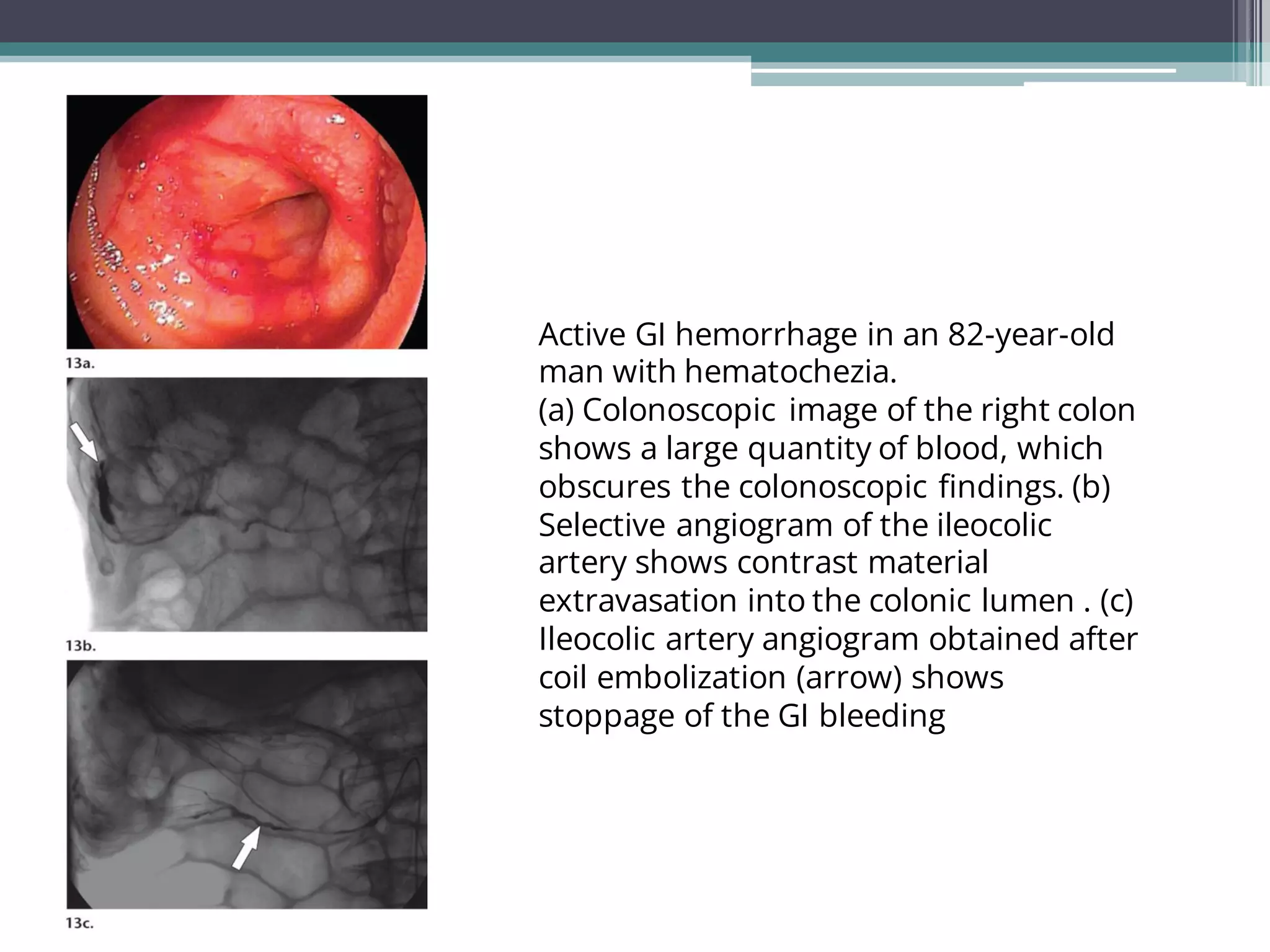 Lower GI bleed.pdf