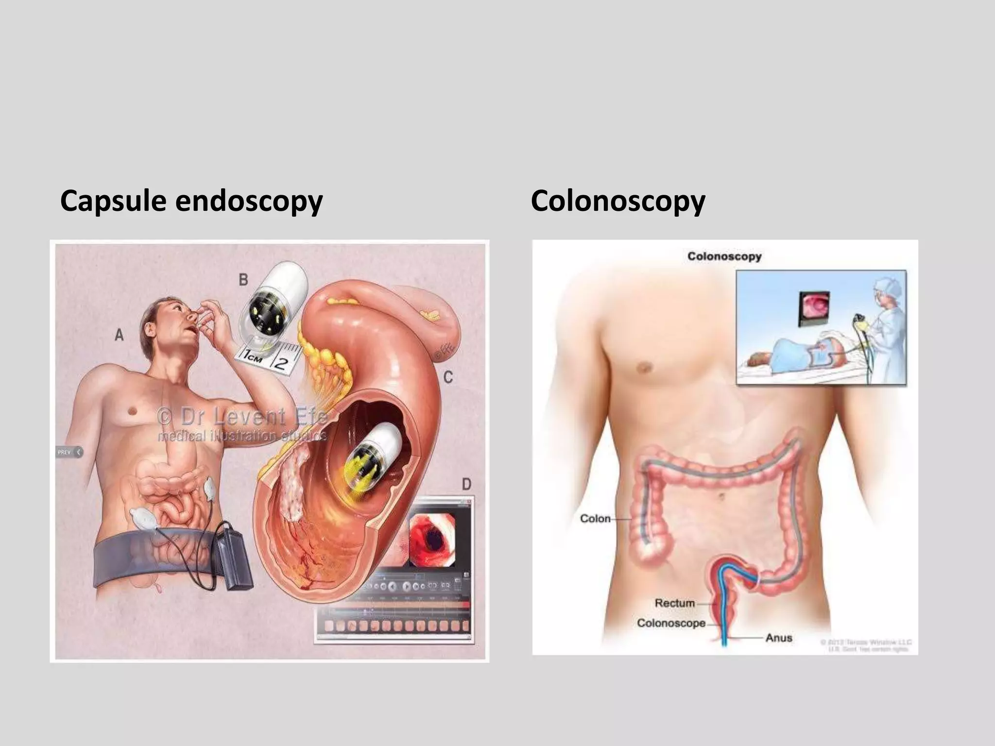 Lower gi bleeding | PPTX