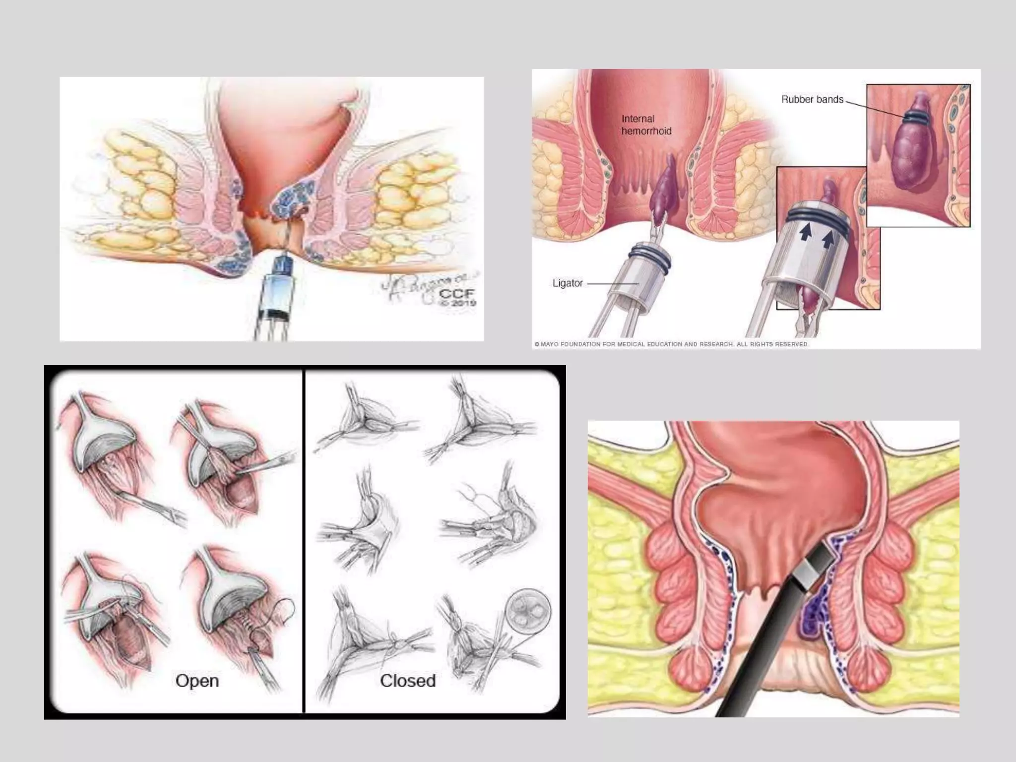 Lower Gi Bleeding Pptx