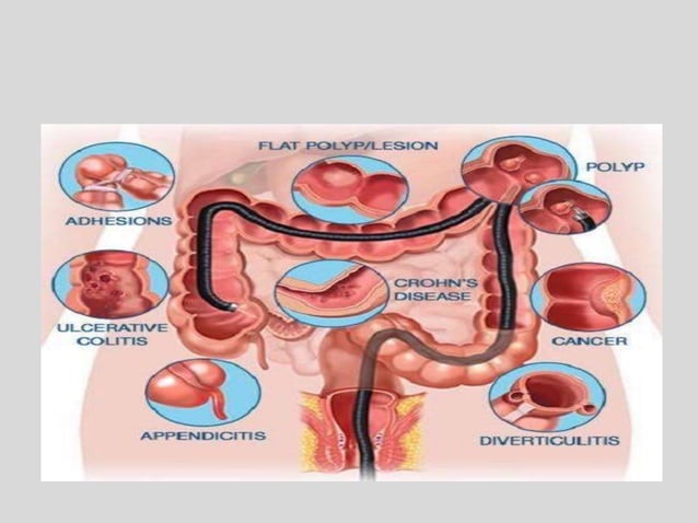 Lower Gi Bleeding Ppt