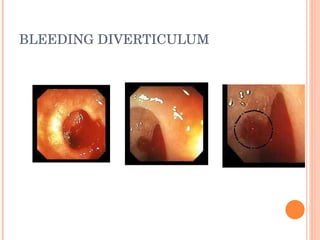 Lower GI Bleeding | PPT