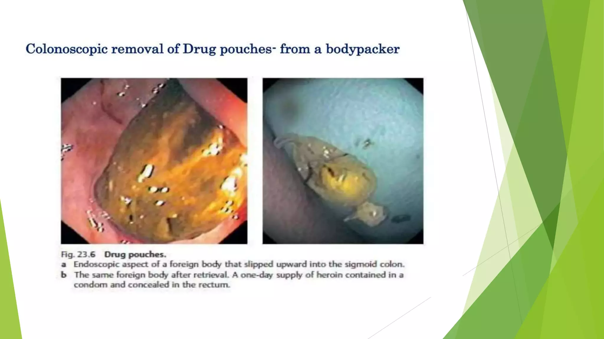 LOWER GI ENDOSCOPY IN SURGICAL PRACTICE.pptx