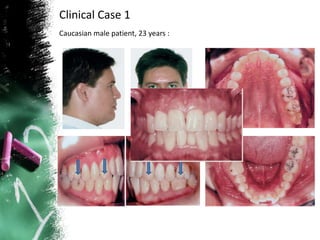 Lower incisor extraction in Orthodontics | PPTX