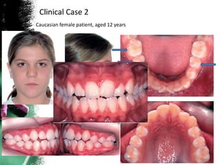 Lower incisor extraction in Orthodontics | PPTX