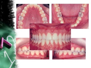 Lower incisor extraction in Orthodontics | PPTX