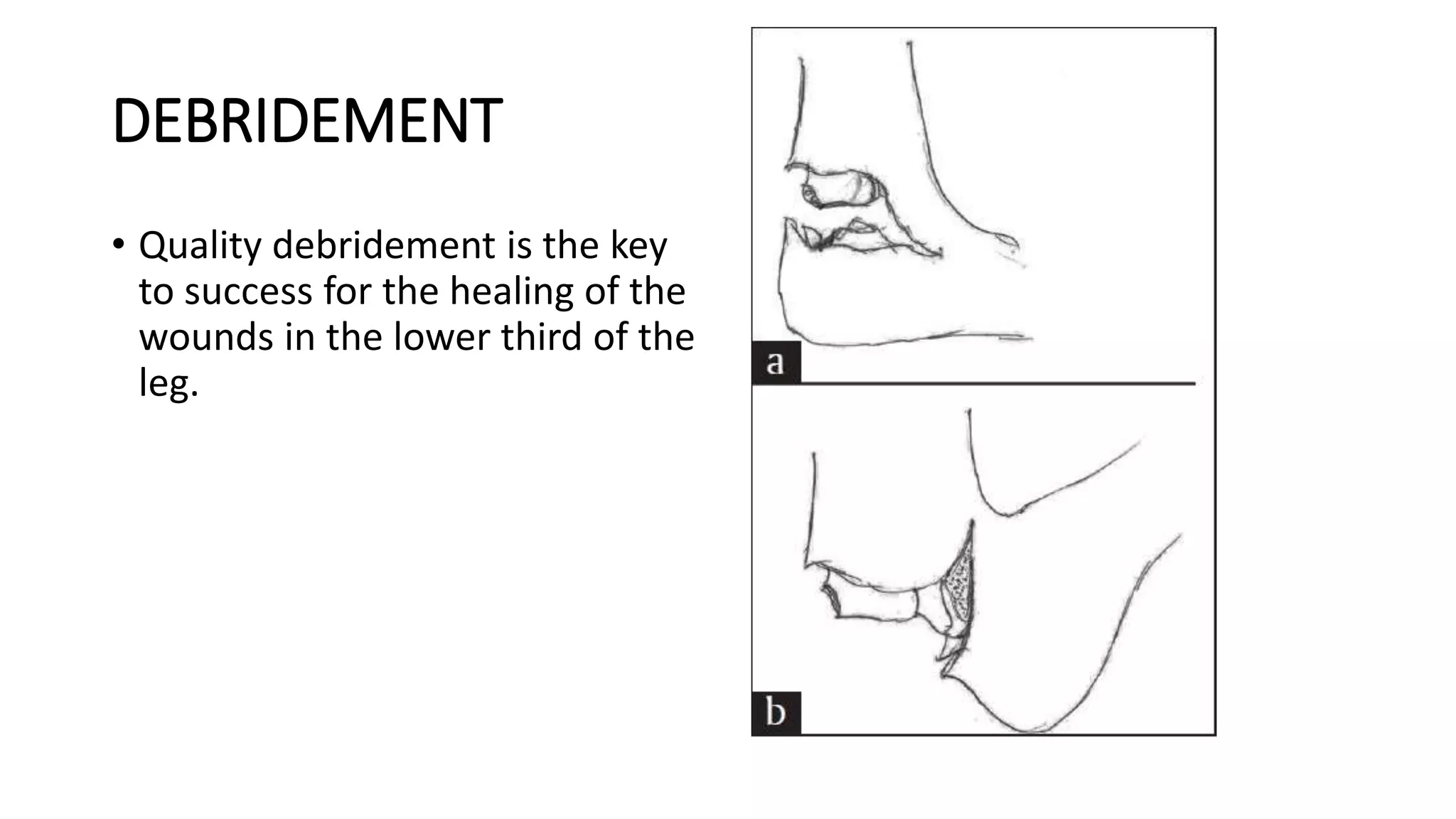 Lower leg defect reconstruction | PPTX