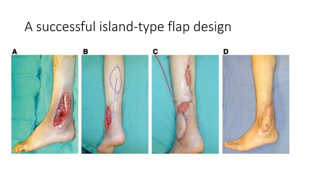 Lower leg defect reconstruction | PPTX | First Aid | Injuries