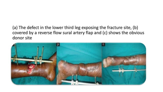 Lower leg defect reconstruction | PPTX | First Aid | Injuries