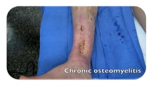 Lower leg defect reconstruction | PPTX