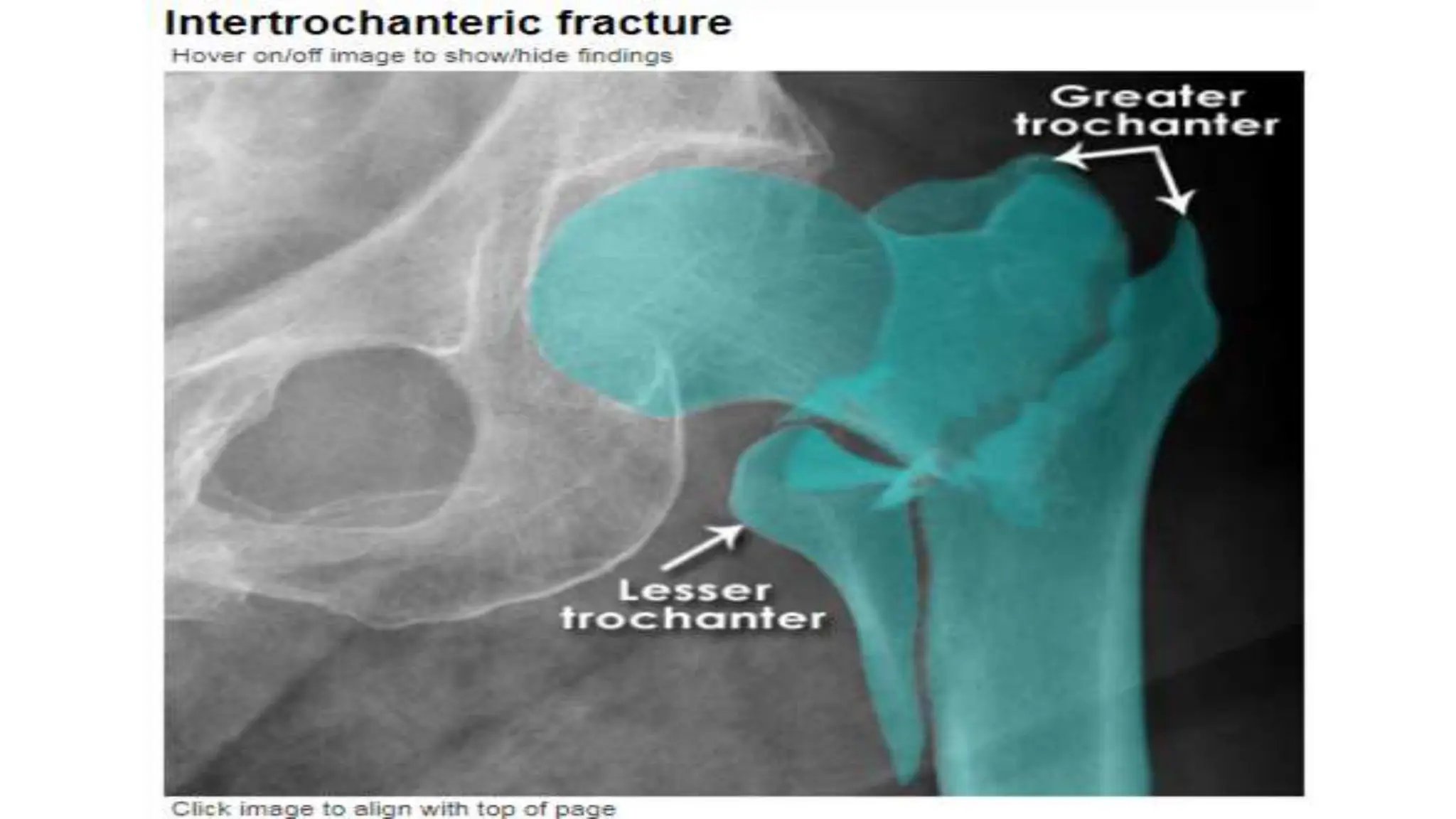 Anatomy and Pathologies Of The Upper limb with special focus on upper ...