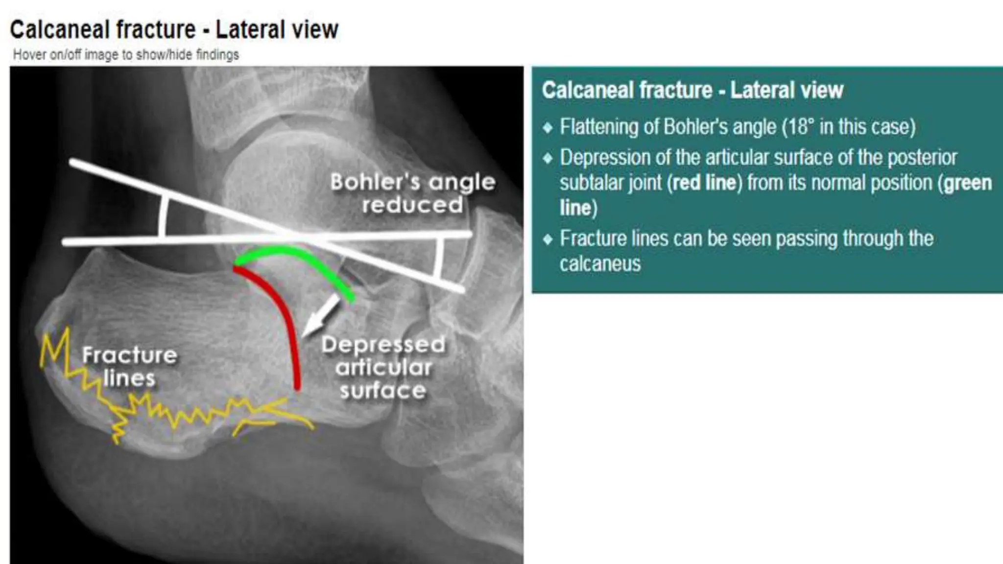 Anatomy and Pathologies Of The Upper limb with special focus on upper ...