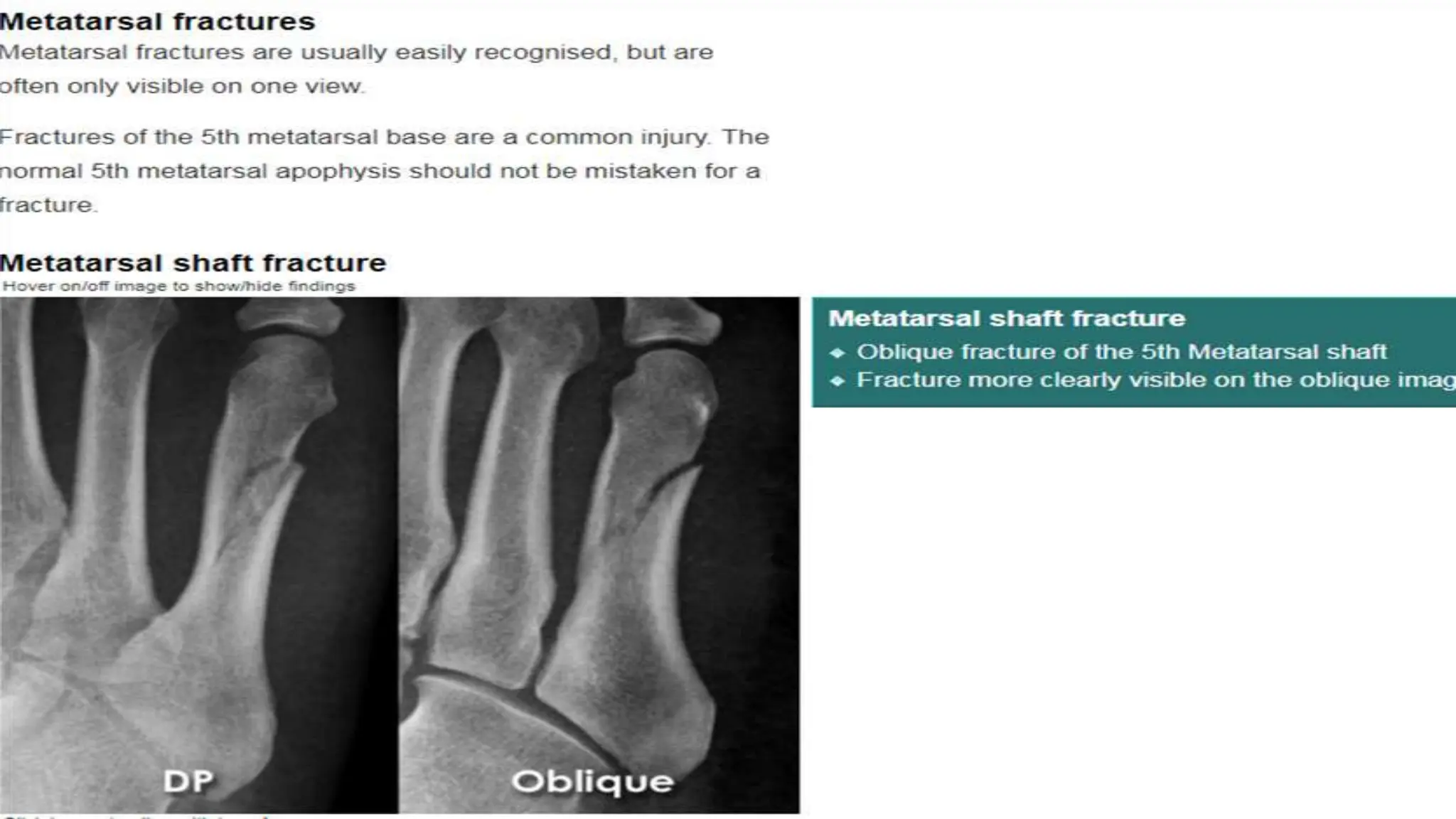 Anatomy and Pathologies Of The Upper limb with special focus on upper ...