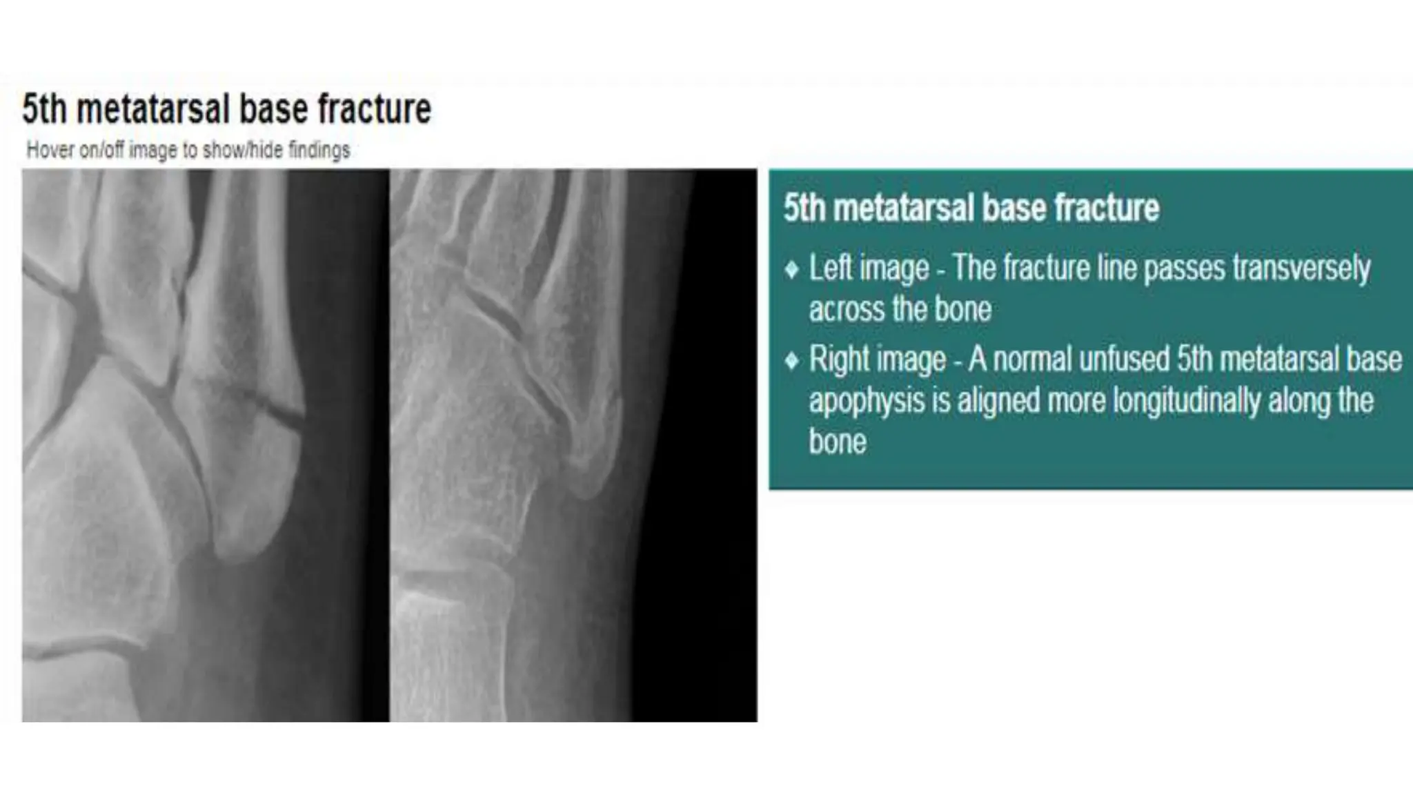 Anatomy and Pathologies Of The Upper limb with special focus on upper ...