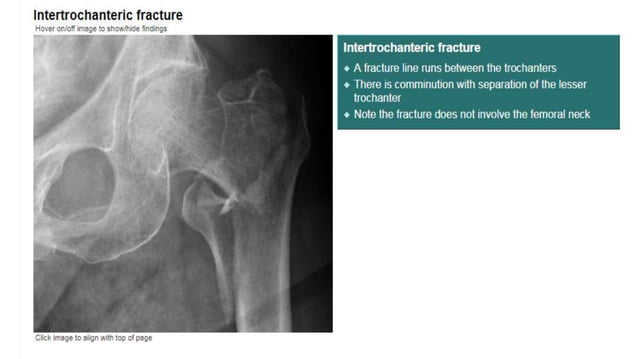 Anatomy and Pathologies Of The Upper limb with special focus on upper ...