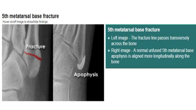 Anatomy and Pathologies Of The Upper limb with special focus on upper ...