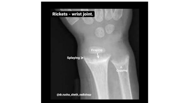 Anatomy and Pathologies Of The Upper limb with special focus on upper ...