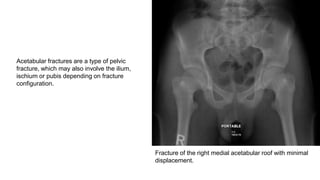 Anatomy and Pathologies Of The Upper limb with special focus on upper ...
