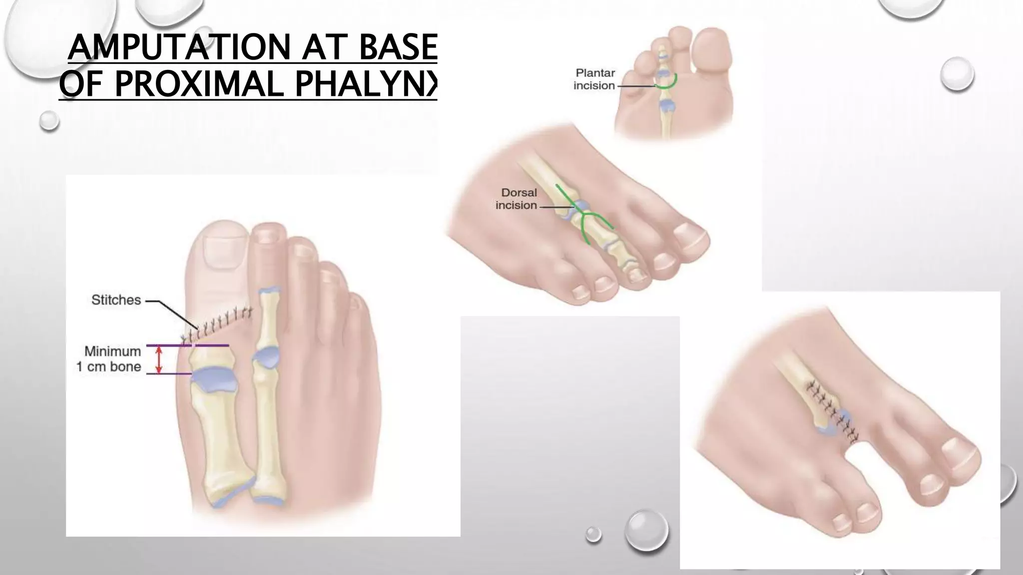 Lower limb amputation | PPTX